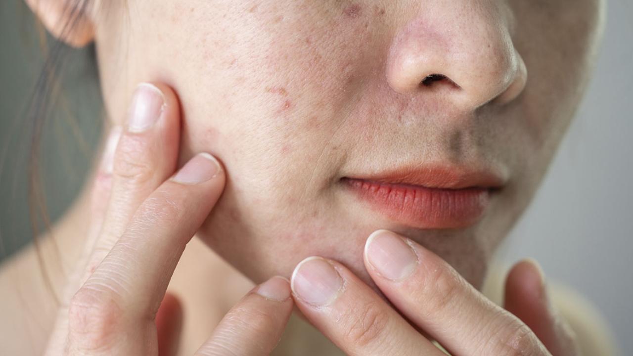 mild acne example