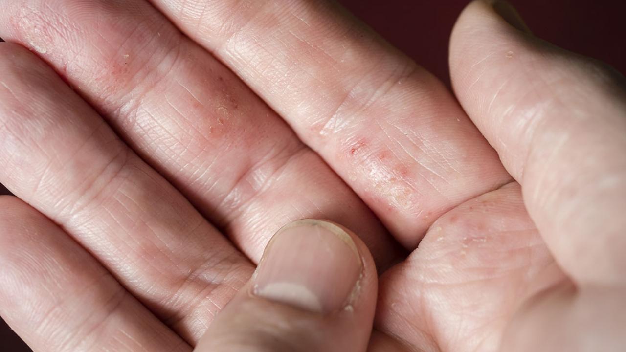 Dyshidrotic Eczema Fingers Dyshidrotic Eczema Fingers